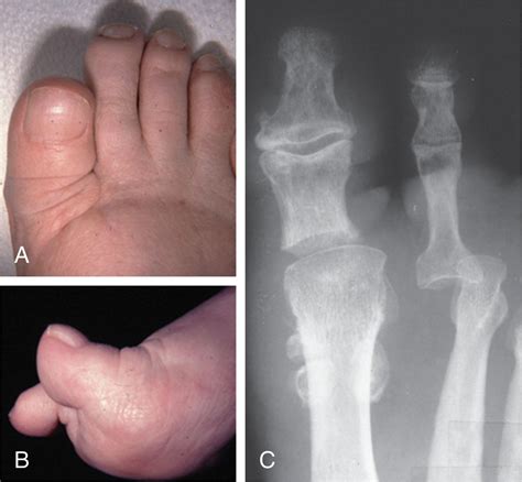 Sesamoids And Accessory Bones Of The Foot Clinical Tree