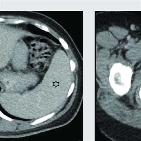 Histopathology Of The Vulvar Lesion Demonstrating Atypical