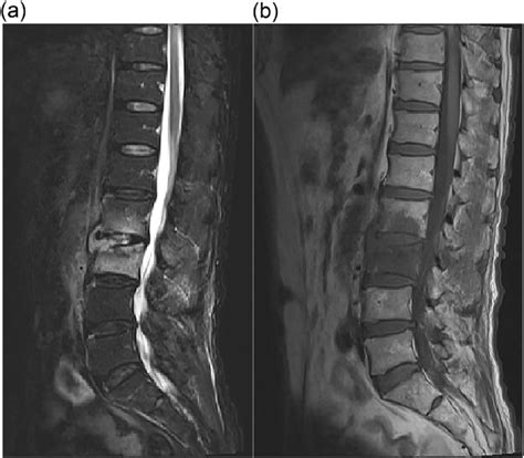 Mri Showing Increased Signal Intensity In Stir A And Decreased Signal