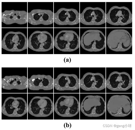论文翻译：x2ct Gan Reconstructing Ct From Biplanar X Rays With Generative Adversarial Networks Csdn博客