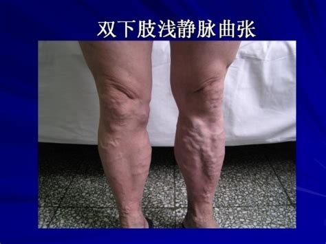 下肢深静脉血栓 360百科