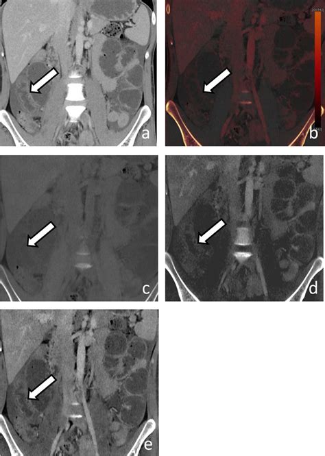 Portal Venous Phase Split Filter Dual Energy Ct Of The Abdomen In A Download Scientific Diagram