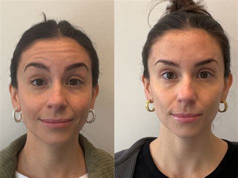 Different Types Of Botox Brands Cult Aesthetics