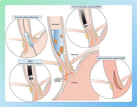 Klaus Mönkemüller On Linkedin An Algorithm For Diagnosis And Management Of Esophageal Dysmotility…