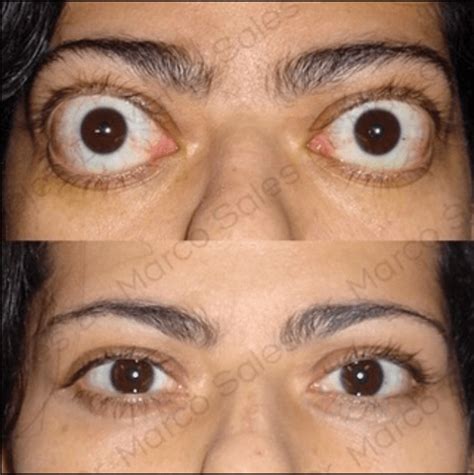 Thyroid Orbitopathy Dr Marco Sales