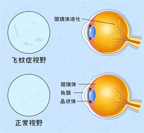 眼前总有“蚊子”在飞？这5种状况得及时治疗！