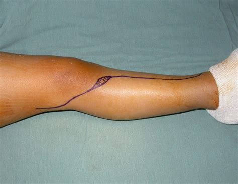 Sarcoma De Ewing Da Tíbia Oncocirurgia