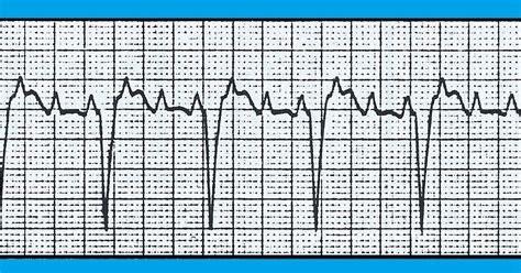 Ecg Interpretation Ecg Blog 137 Svt Av Block Atrial Flutter Atrial Tachycardia Atrial