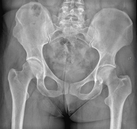 Normal Pelvis X Ray