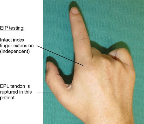 Tendon Transfers For Rheumatoid Tendon Attrition Rupture Clinical Tree