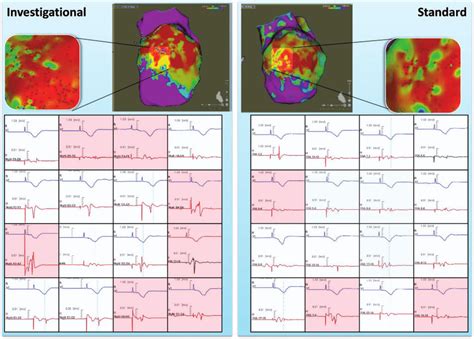 Local Characteristics In Left Ventricular Scar The Left And Right Download Scientific Diagram