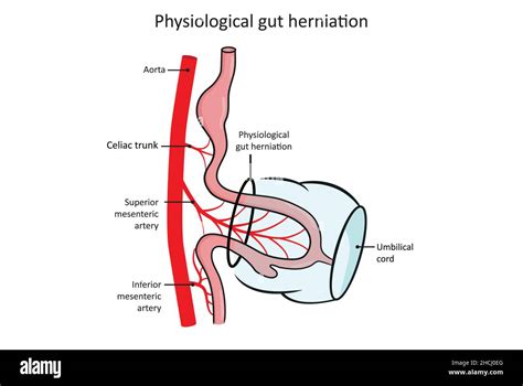 Physiological Hernia Cut Out Stock Images And Pictures Alamy