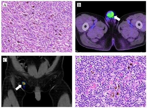 Penile Dynamic Sentinel Lymph Node Biopsy Medicine21