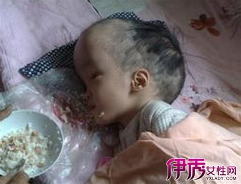 【脑瘫的临床表现图片】【图】脑瘫的临床表现图片大全 8个方法教你预防小儿脑瘫 伊秀亲子