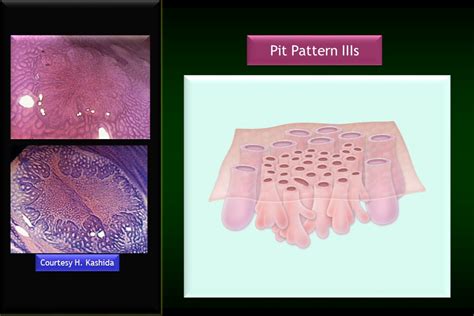 Pit Pattern Classification Colon Explorer
