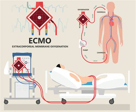 Venoarterial Extracorporeal Membrane Oxygenation In 43 Off
