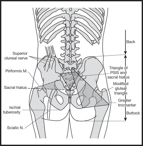 Multifidus Triangle Syndrome