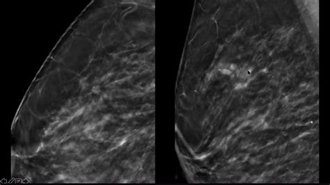 Diagnostic Breast Imaging And Interventions In The Age Of Digital Breast Tomosynthesis Els