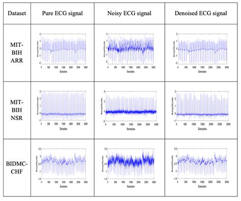 4 Original Noisy And Denoised Ecg Signal Download Scientific Diagram