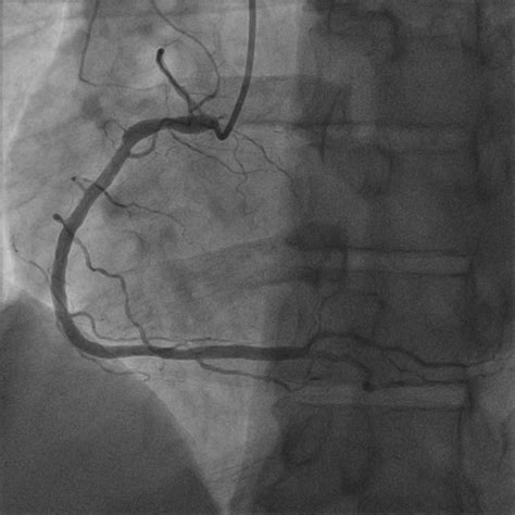 Artery Detection Object Detection Dataset By Projects