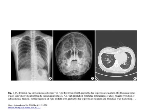Fig 1 A Chest X Ray Shows Increased Opacity In Right Lower Lung