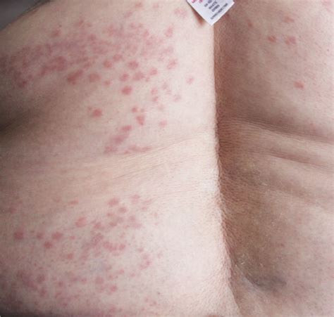 Diabetes Skin Lesions