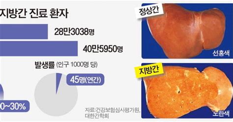‘건강한 근육 키워야 간 섬유화 막는다