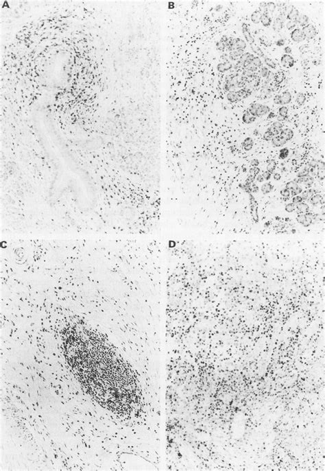 Different Patterns Of T Lymphocyte Distribution Identified In Chronic Download Scientific