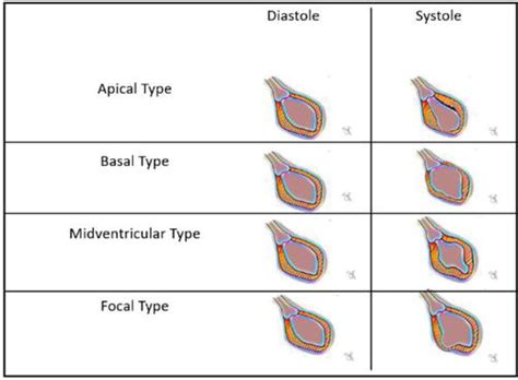 Takotsubo Cardiomyopathy Intechopen
