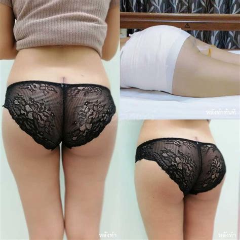 Buttock Augmentation Gallery Lelux Hospital