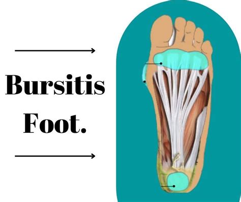 Bursitis Foot The Prolotherapy Clinic