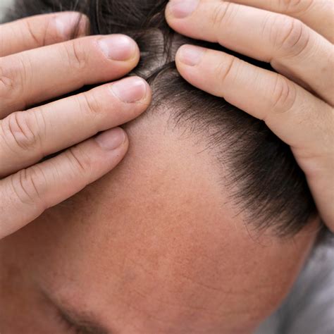How To Control Scalp Acne