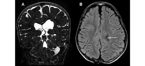 A Left Cerebellar Hemiatrophy And B Subependymal Heterotopia Arrow In Download Scientific