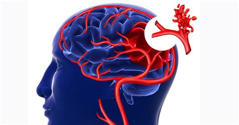 What Is Brain Cerebral Aneurysm Symptoms Causes Treatment Lights Crystal