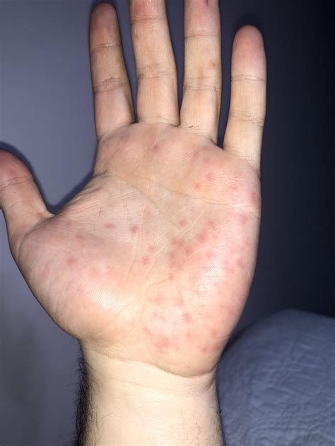 What Is This Rash On My Hands And Feet