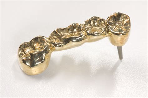 Options For Replacing A Missing Tooth