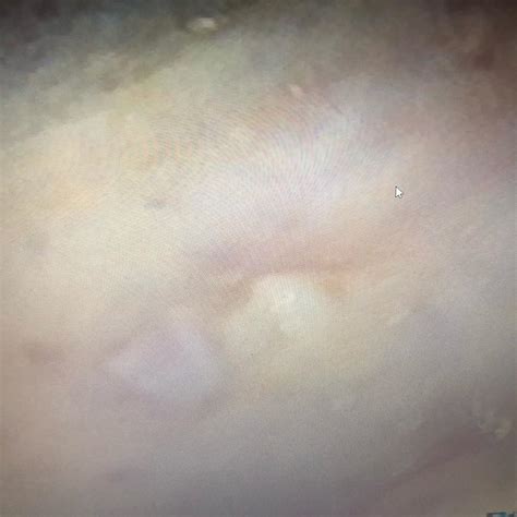 Úlcera Duodenal Forrest Iia Tratada Endoscopia Integral Facebook