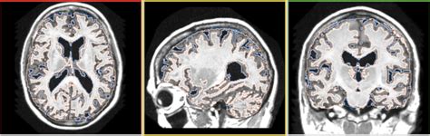 Modulesfuzzysegmentationmodule Slicer Wiki