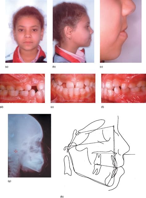 Figure 6 From Pseudo Class Iii Malocclusion Treatment With Balters