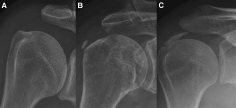 X Ray Calcific Tendonitis Shoulder At Randall Starkes Blog
