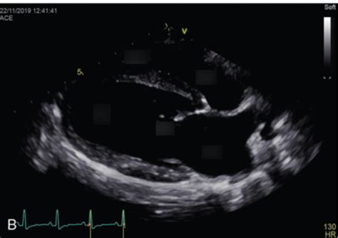 Label The Echo Picture Long Axis Right Parasternal 4 Chamber View