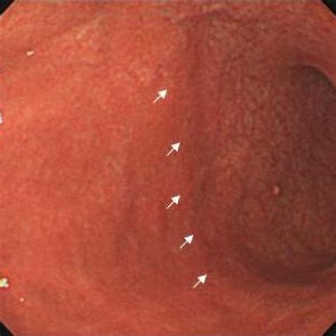 Classification Of An Endoscopically Evident Atrophic Pattern The Download Scientific Diagram