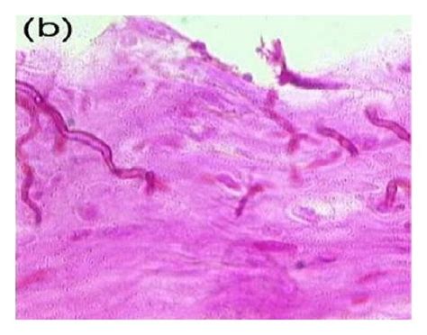 Interdigital Fungal Intertrigo A Interdigital Whitish Plaques With