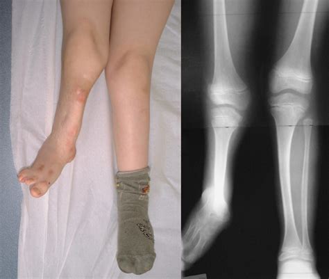 Hypoplasie Inégalité Et Malformation Membres Inférieurs