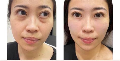 許惠翔美學診所 蘋果肌填充少女針打造澎潤立體感改善中臉下垂與淚溝台中竹北新竹醫美診所