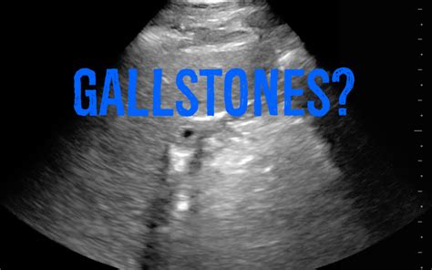 Hennepin Ultrasound Gallstones