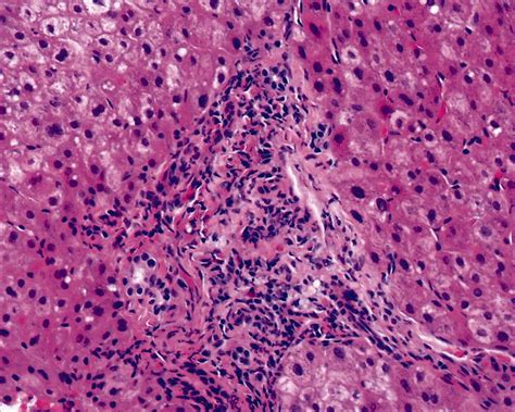 Metformin Induced Cholangiohepatitis Bmj Case Reports