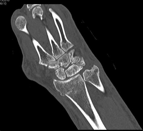 Radial Styloid Fracture