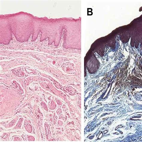 Inflammatory Fibrous Hyperplasia Associated With Well Circumscribed