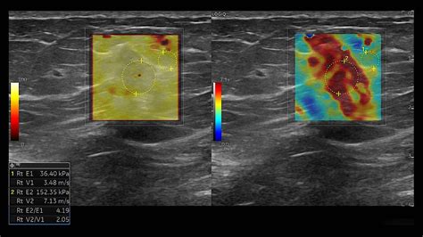 Advanced Breast Imaging Solutions Ge Healthcare Ge Healthcare
